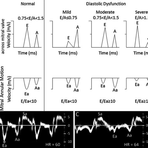 Doppler Flow Schematic And Patient Tissue Doppler Example A E Is The