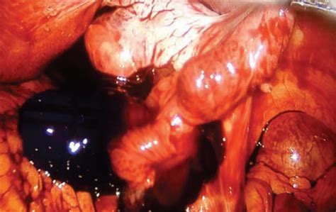 Blue Eye Sign Of Ectopic Pregnancy On Transvaginal Sonography