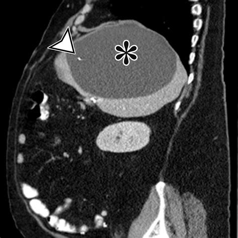 Approach To Cystic Lesions In The Abdomen And Pelvis With Radiologic