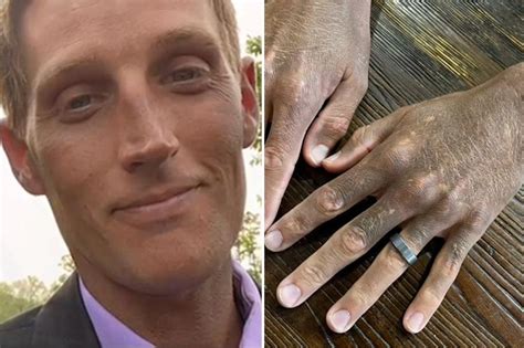 Mans Skin Turns Black From Reaction To Antidepressant Prozac