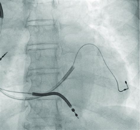 Coronary Sinus Angiogram Showing A Large Posterolateral Vein Figure 2
