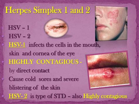 Ppt Viral Diseases Powerpoint Presentation Free Download Id7074301