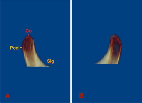 Three Dimensional Relationships Between Condylar Volume And