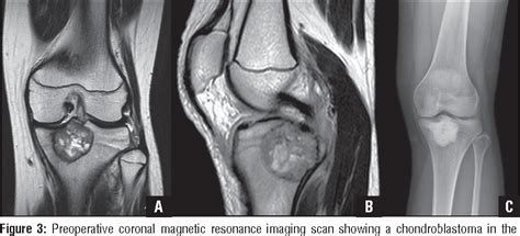 Chondroblastoma