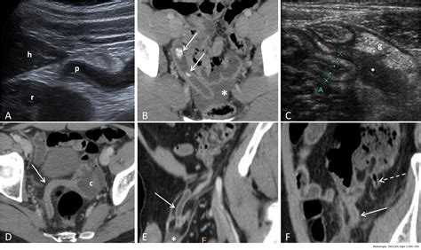 Update On Acute Appendicitis Typical And Untypical Findings