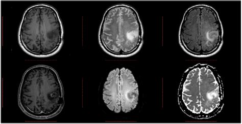 Evaluating Brain Tumor Detection With Deep Learning Convolutional