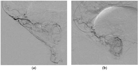 Prostatic Artery Origin Variability Five Steps To Improve Identification During Percutaneous