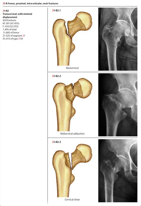Fractures Of The Femur Musculoskeletal Key