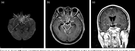 Figure 1 From Late Onset Cerebral Vasculitis With Tuberculous