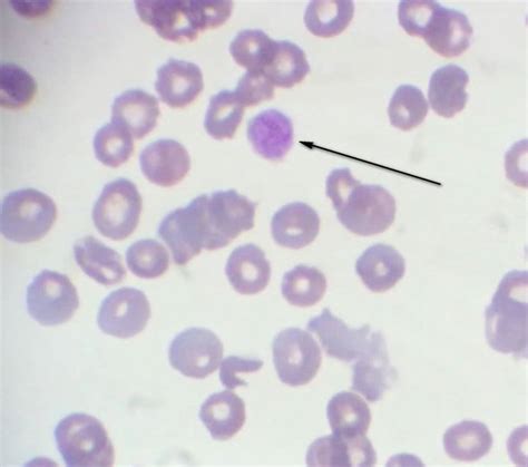 Eritrociti Nelle Urine Esami Clinici Esami Urine