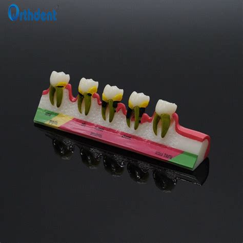 Dental Lab Teeth Model 5 Stage Periodontal Tooth D Vicedeal