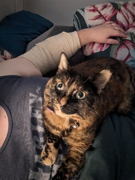 Day After Decompression Surgery On Nhs Ama Rcubitaltunnel