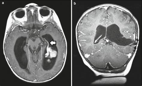 Choroid Plexus Tumors Oncohema Key