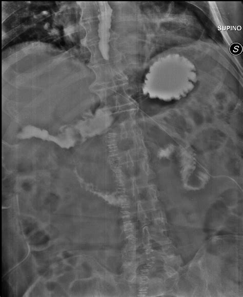 Biliary Enteric Fistula Pacs
