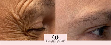 Before And After Photos Neurotoxin Ohara Dermatology