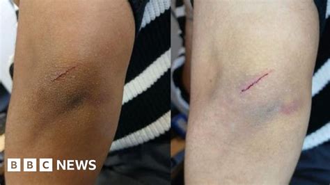 Met Police Tool Used To Help See Bruises On Those With Dark Skin