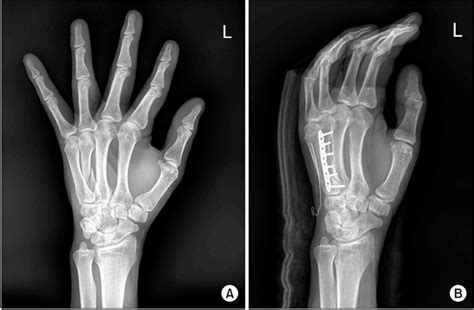 Comparison Of Intramedullary K Wire Nailing Versus Plate For Fixation In Metacarpal Midshaft