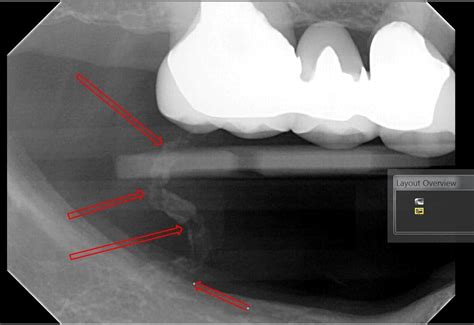 What Is The Difference Between Periapical And Bitewing X Rays At Grady