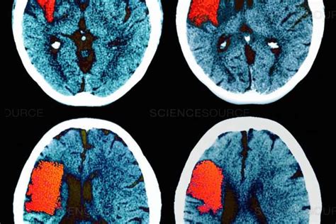 Understanding The Stroke Dementia Connection Ucla Health