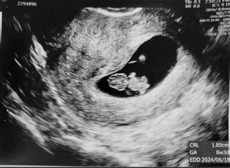 임신 8주차 9주차 초음파 젤리곰 수성구 보건소 임산부 등록하기 네이버 블로그