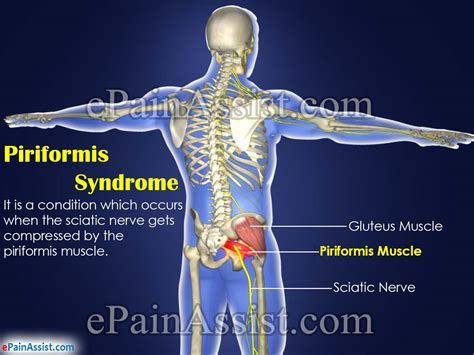 Piriformis Muscle Strain