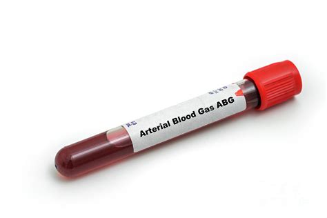 Arterial Blood Gas Test By Science Photo Library