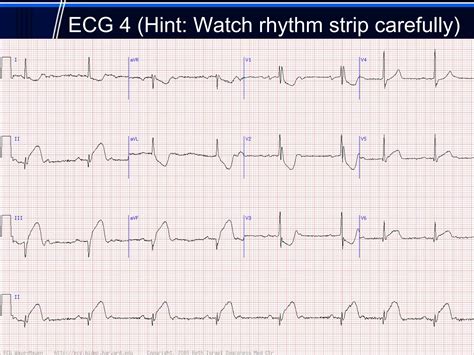 Ecg Approach To Arrhythmias 2017 Ppt Heart And Cardiovascular Diseases Diseases And Conditions