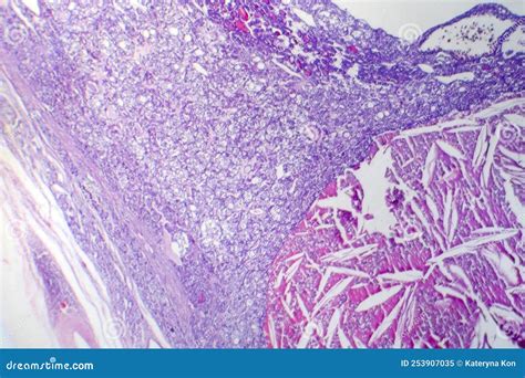Thyroid Follicular Carcinoma Light Micrograph Stock Image Image Of Medical Follicular 253907035