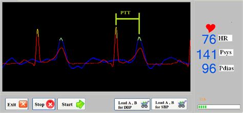 extract of pulse transit time from ecg and pulse signals by the