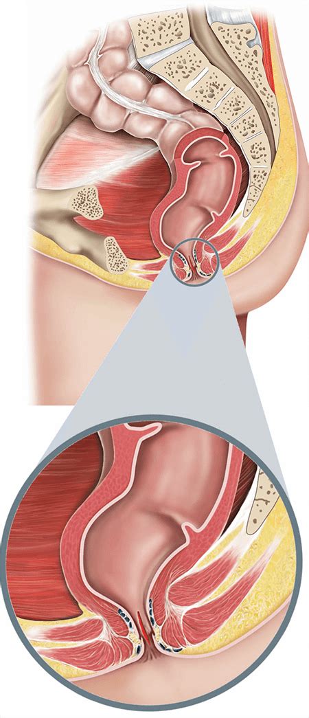 Lateral Internal Sphincterotomy Anal Fisssure Brisbane Colorectal