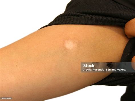 Closeup Of A Cigarette Burn Scar On Human Arm Indicating Selfharm And
