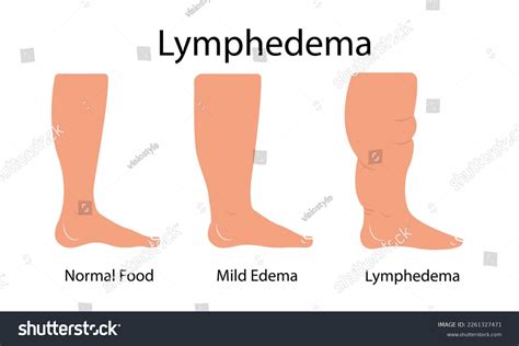 Lymphedema Stages Lymphatic System Dysfunction Disease Stock Vector