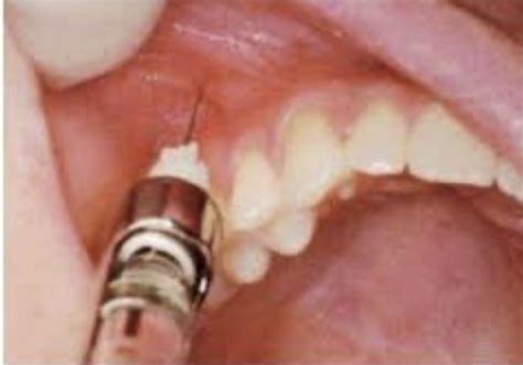 Maxillary Nerve Blocks Flashcards Quizlet