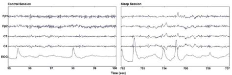 Five Second Segments Of Eeg And Eog Measurements During The Cs And The