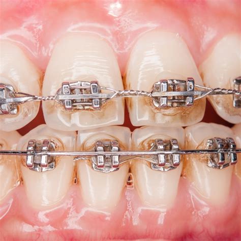 ¿puedo Realizarme Un Tratamiento De Ortodoncia Si Tengo Periodontitis