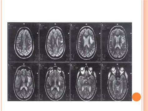 Aphasia And Types PPTX Brain And Nervous System Disorders Diseases And Conditions