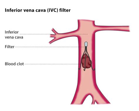 Inferior Vena Cava Ivc Filter Placement Benefits And Risks How To Relief