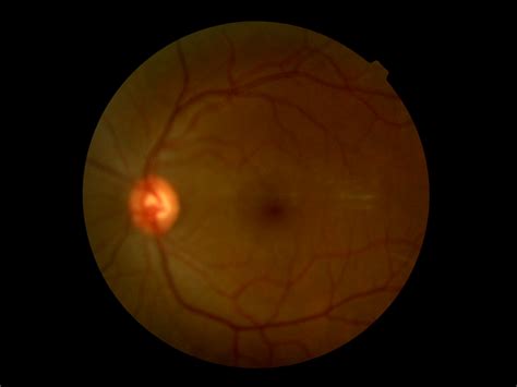 Dr Detection Roboflow Universe