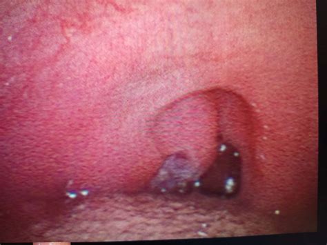 Tonsil Stones And Tonsillitis Can Look Like Tonsil Ulcers