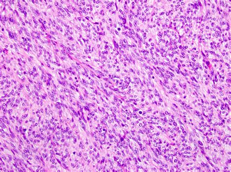 Pathology Outlines GIST