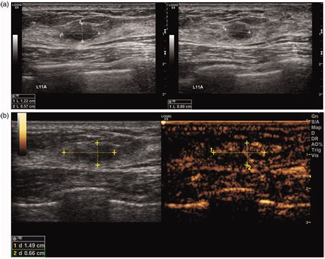 Contrast Enhanced Ultrasonography Of A Solid Breast Nodule A Using Download Scientific