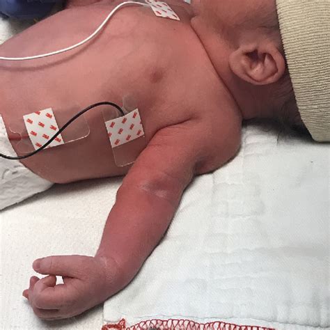 Figure 1 From Congenital Anterior Shoulder Dislocation In A Newborn