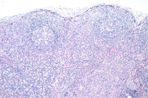 Normal Lymphoid Tissues Part 2 11