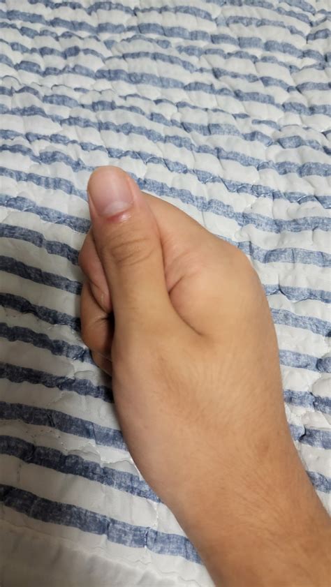 엄지손가락에 붉은 무언가가 계속 사라지지 않습니다 지식in