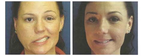 Decompression Syndrome Decompression Sickness Causes Symptoms And Treatment Of ‘the Bends