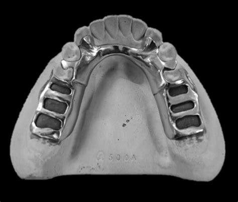 Learn Kennedy Classification In Rpd A Guide For Dental Practices