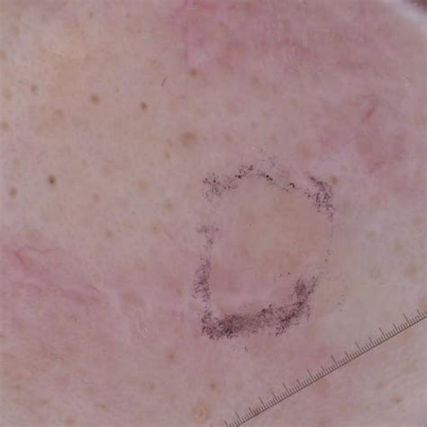 Anil Adepumelanoma Classification Using Knowledge Distillation For