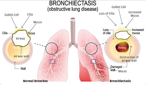 Bronchiectasis Sputum Culture
