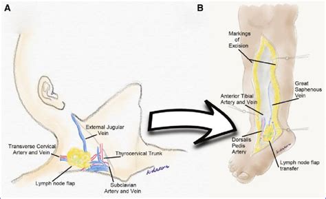 Diagram Of Lymph Node Transfer And Excisional Procedures Markings Of