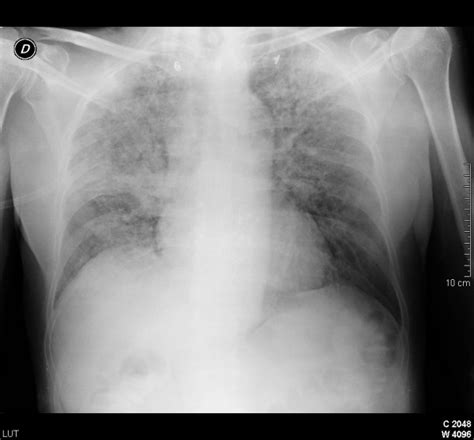 Diffuse Bilateral Interstitial Infiltrates Were Predominant In Upper
